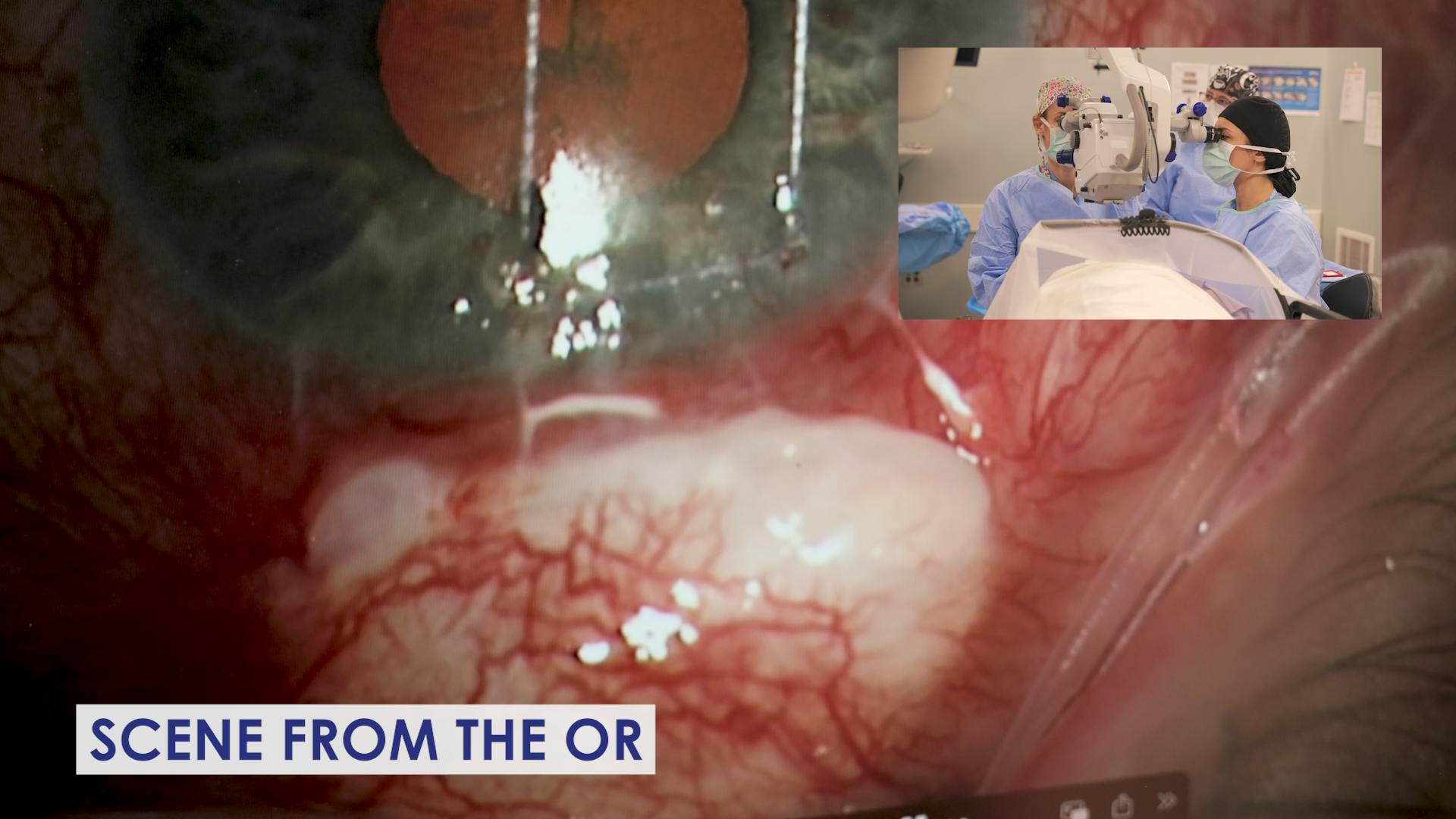 Revision Of An Ischemic Focal Bleb Eyetube